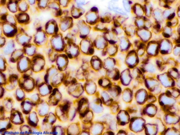 Carcinoma de células de Merkel. - Instituto de Patología Alicante