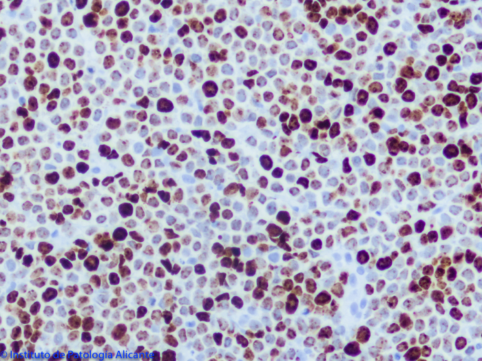 Carcinoma de células de Merkel. - Instituto de Patología Alicante