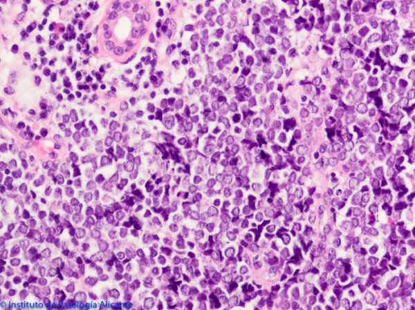 Carcinoma de células de Merkel. - Instituto de Patología Alicante