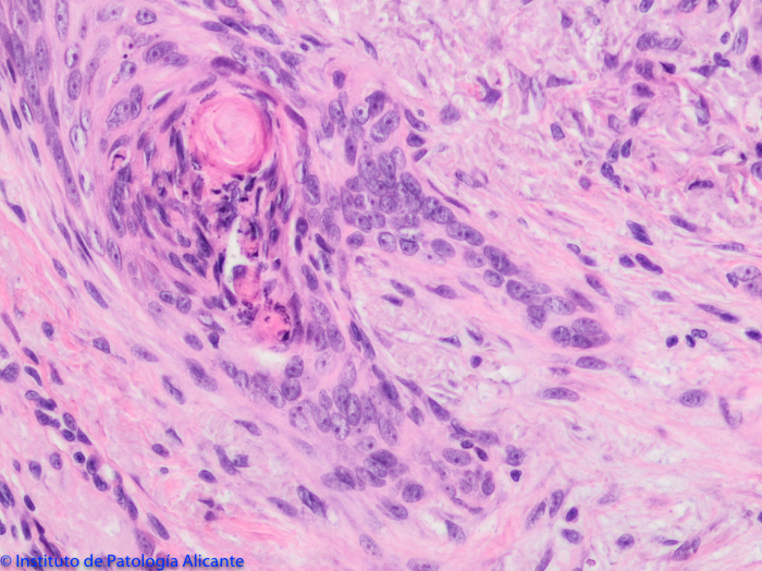 Carcinoma basocelular - Instituto de Patología Alicante