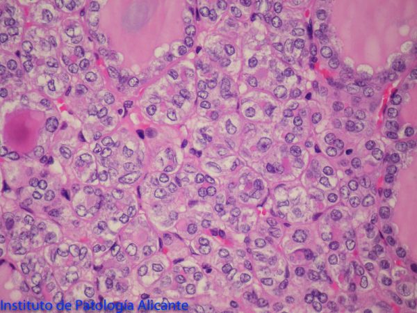 Cáncer de tiroides. Anatomía Patológica. Biopsia y PAAF.