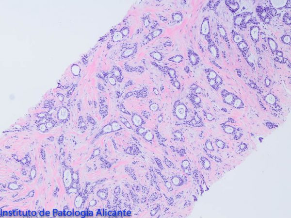 Cáncer De Mama Instituto De Patología Alicante